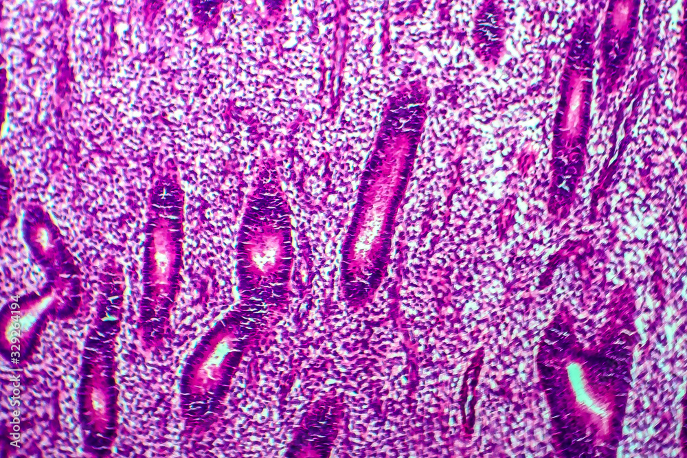 Endometrial hyperplasia, light micrograph, photo under microscope Stock ...