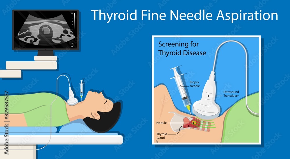 Thyroid cancer disease nodules ultrasound screening check medical treat ...