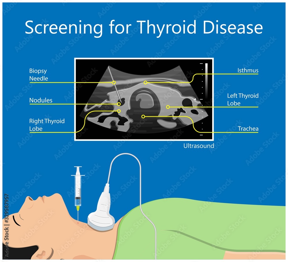 Thyroid cancer disease nodules ultrasound screening check medical treat ...