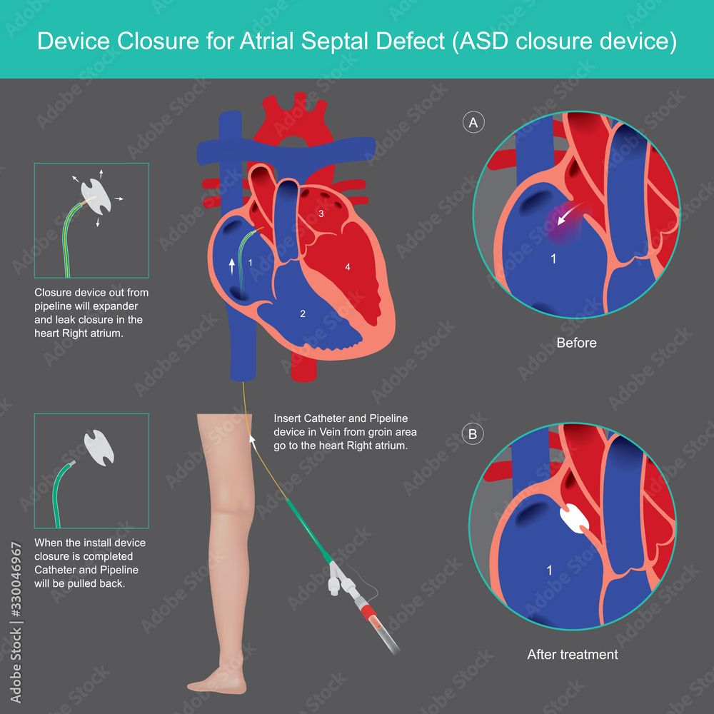 Devices Closure For Atrial Septal Defect Explain Treatment The Atrial