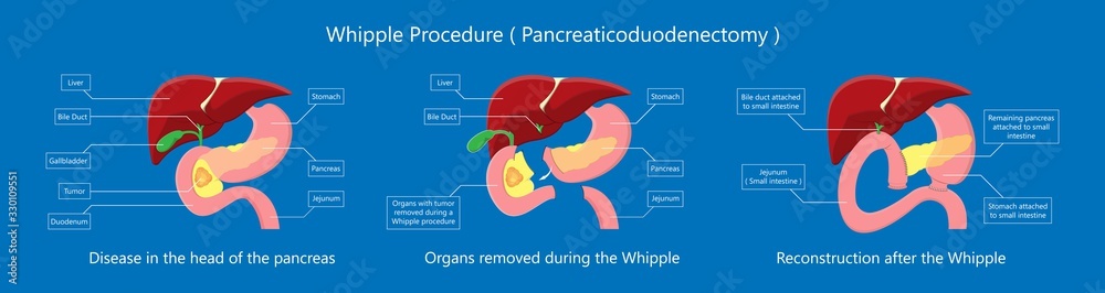 Whipple procedure pancreaticoduodenectomy Pancreatic cancer treatment ...