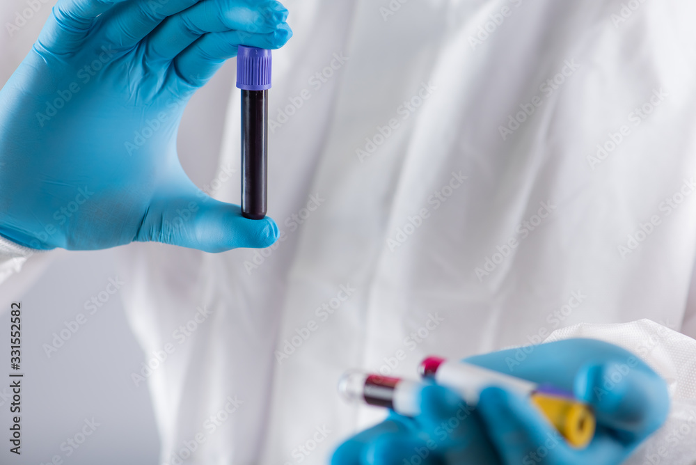 man's hand holding blood in a test tube close up, physical examination ...