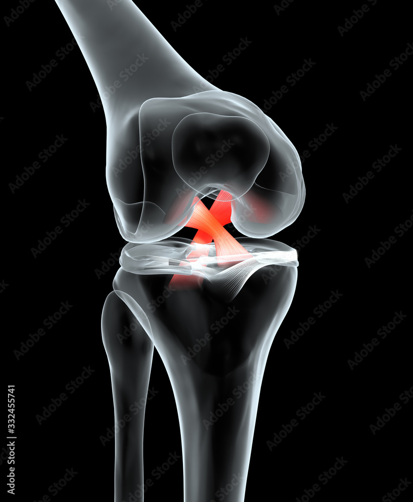 Painful knee joint with highlighted anterior and posterior cruciate ...