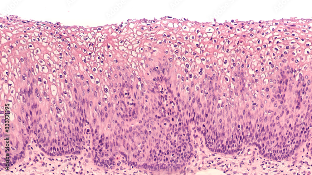 Photomicrograph (microscopic image) of cervix biopsy showing low grade ...