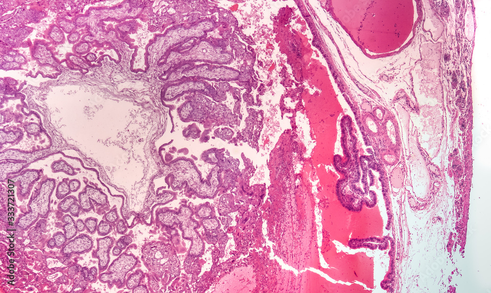 Ectopic pregnancy is a condition in which an embryo attaches outside ...