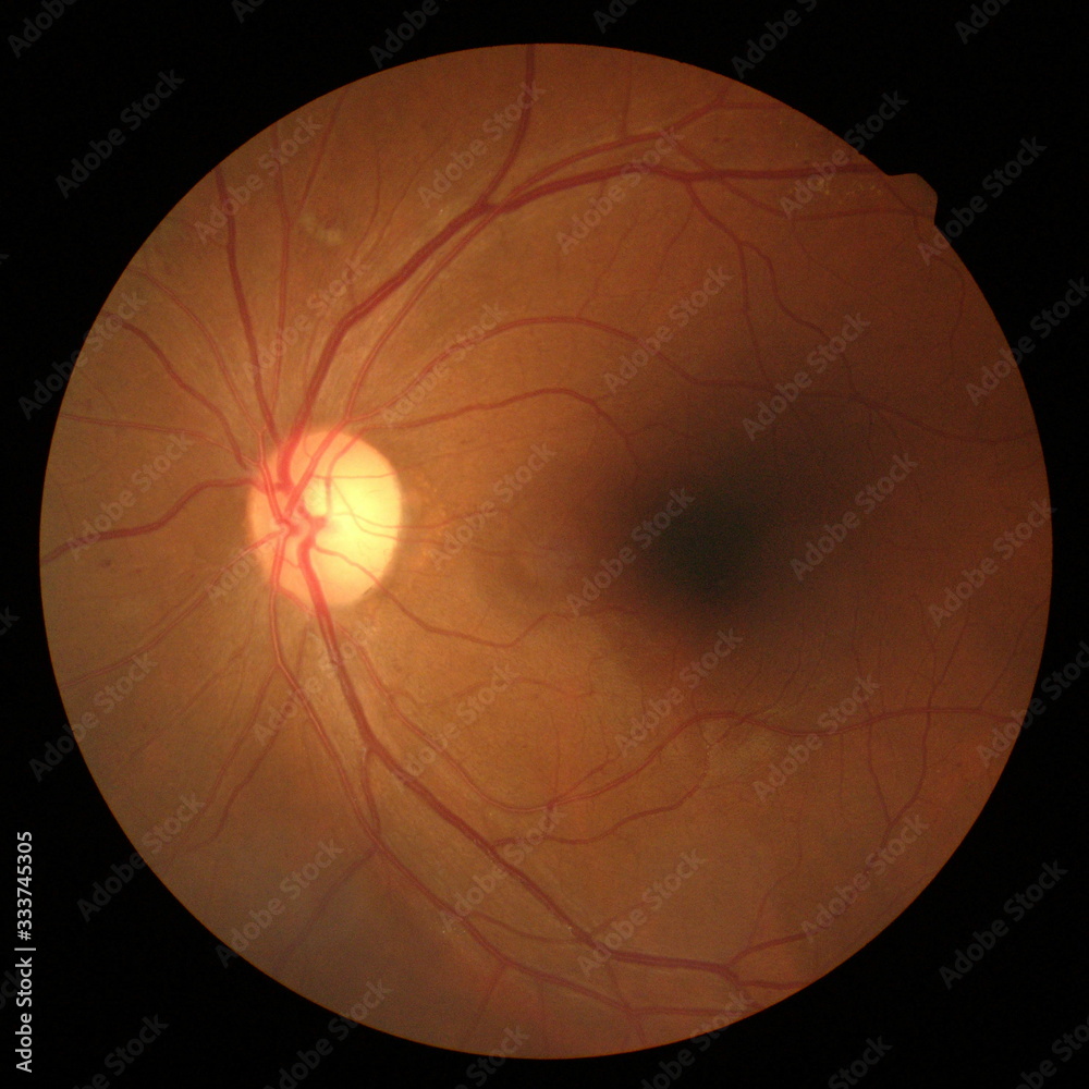 Retinal picture ,Medical photo tractional (eye screen) retinal ...