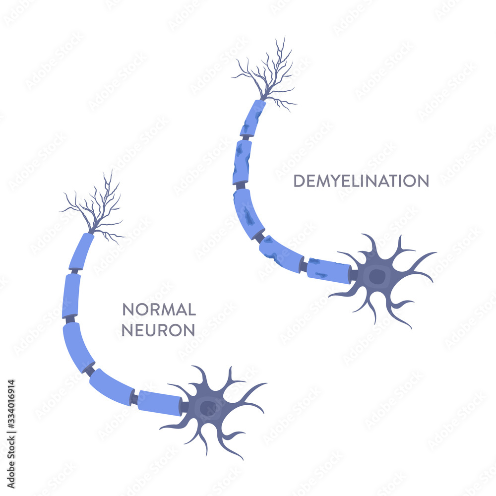 Healthy and damaged neuron diagram. Demyelination of neuron shealth ...