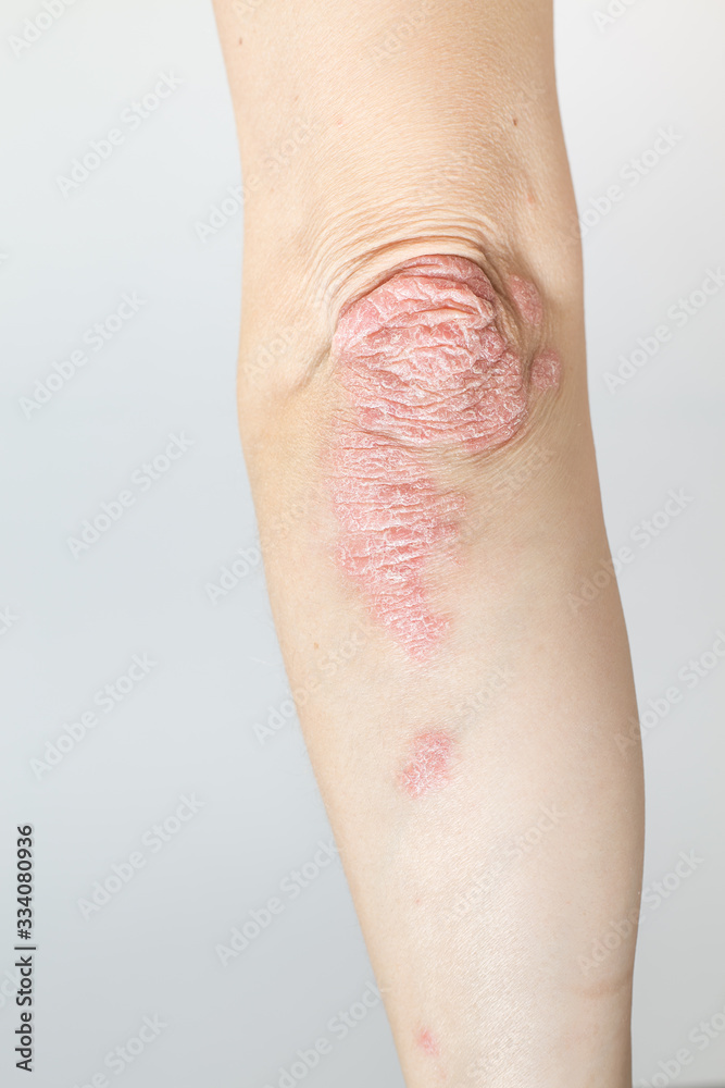 Acute psoriasis on elbows is an autoimmune incurable dermatological skin disease. Large red ...