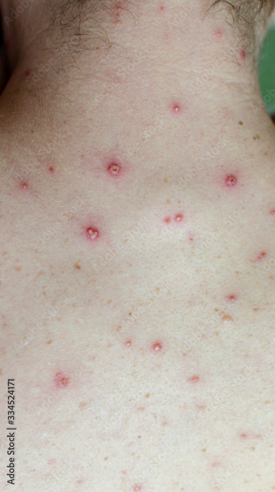 Large spots and pimples acne on the body - adult body with chickenpox ...