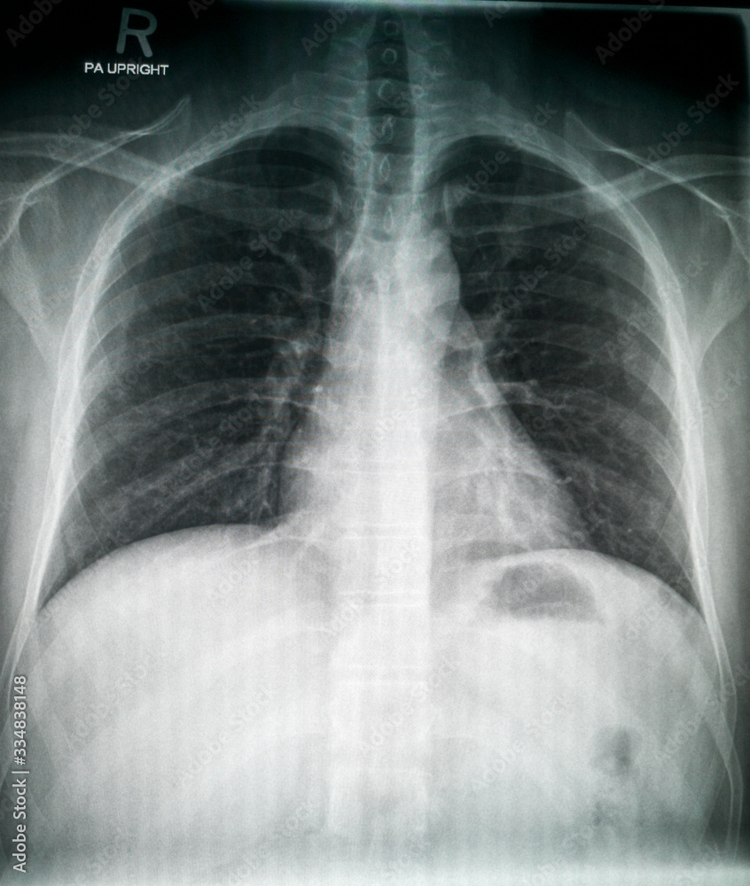 Chest X-Ray of Normal male patient high quality image showing normal ...