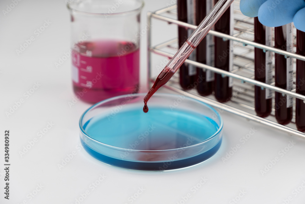Methylene blue test liquid with blood sample for test, laboratory ...