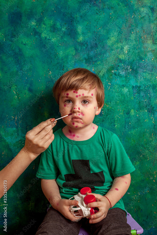 ,boy with chickenpox. Sick child with chickenpox. Varicella virus or ...
