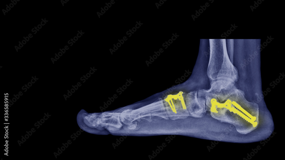 Film X-ray foot radiograph show Flat foot deformity (pes planus or ...