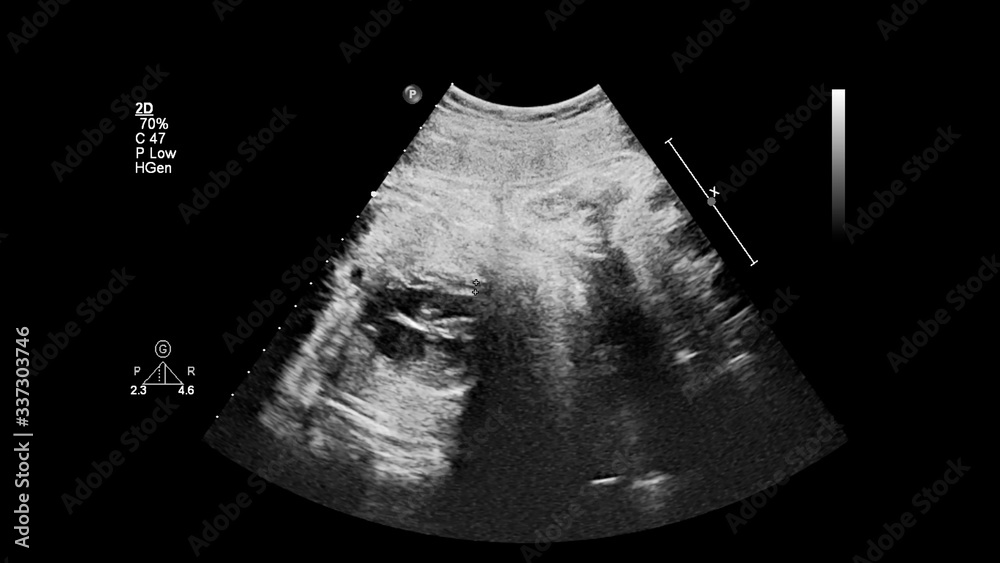 Ultrasound screen with fetal echocardiography Stock Illustration ...
