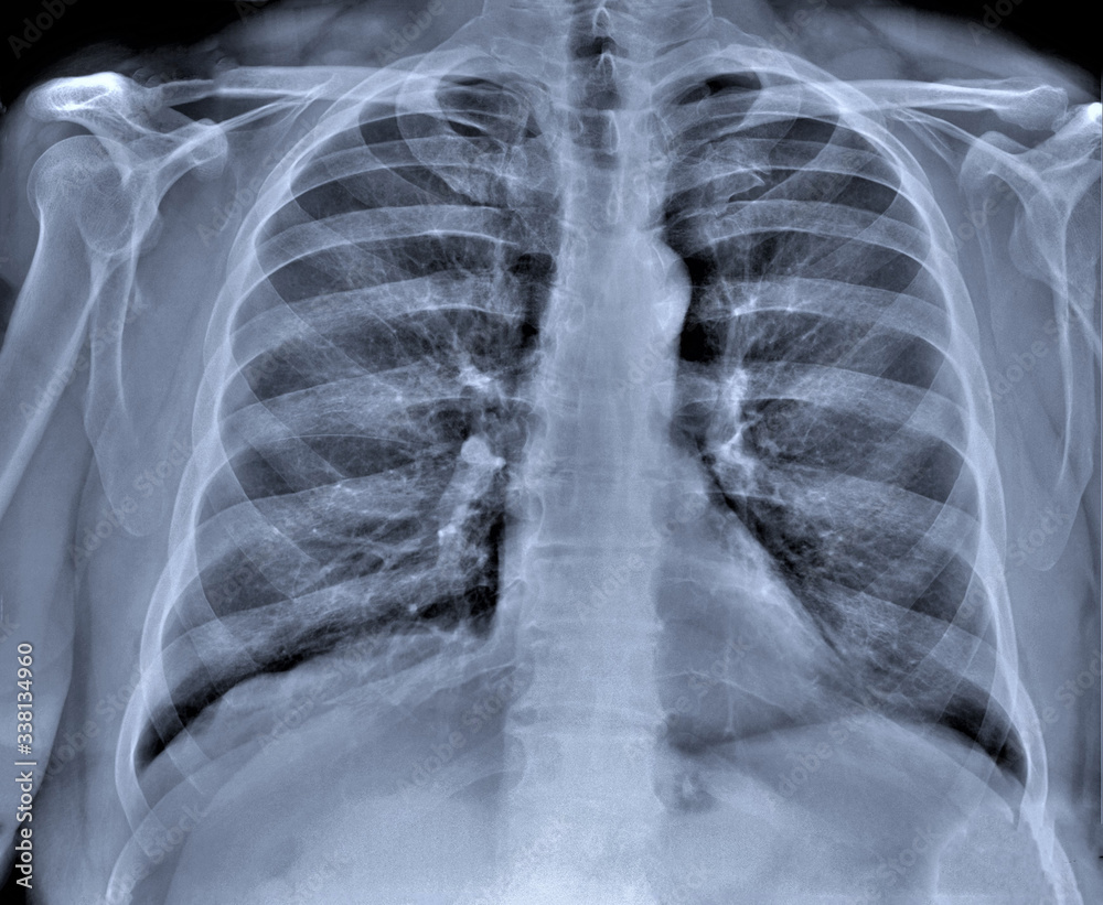 normal chest x-ray, diagnosis of pneumonia Stock Photo | Adobe Stock