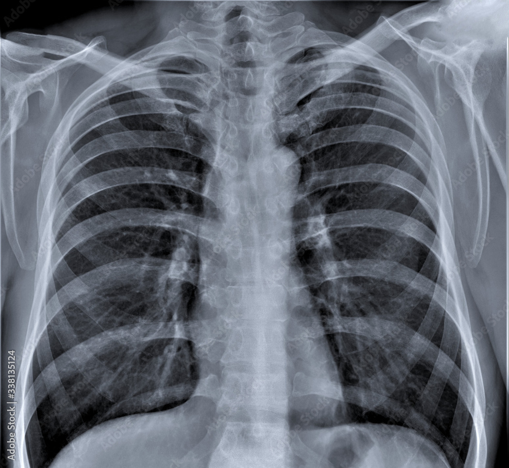 normal chest x-ray, diagnosis of pneumonia Stock Photo | Adobe Stock