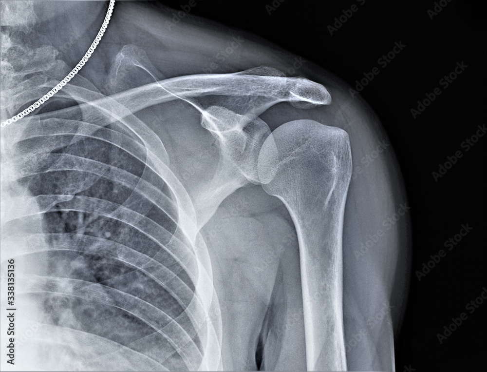 x-ray of the shoulder joint, diagnosis of bone pathology Stock Photo ...