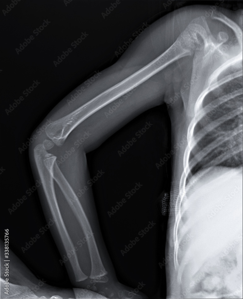 Photo Stock x-ray of the forearm and shoulder bones with the elbow ...