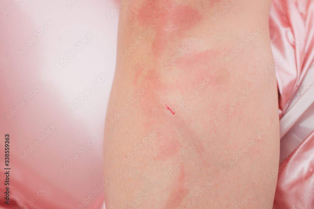 Dermatitis Herpetiformis skin rash in a woman with Nonceliac Gluten ...