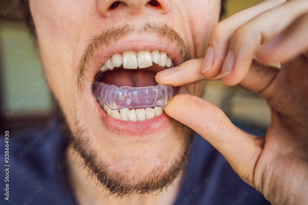 Man placing a bite plate in his mouth to protect his teeth at night ...