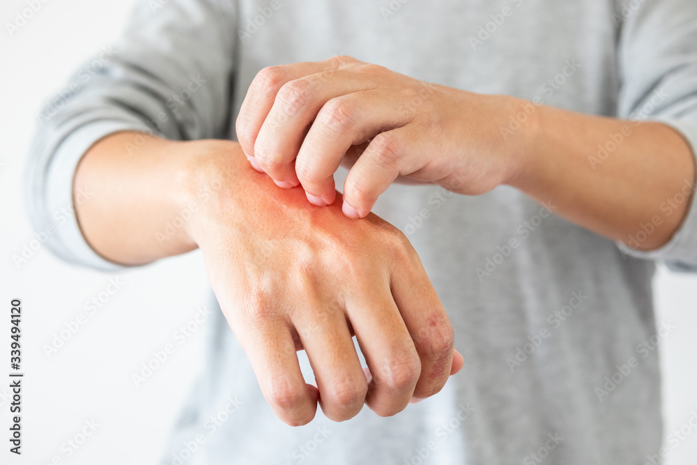 Young asian man itching and scratching on hand from itchy dry skin ...