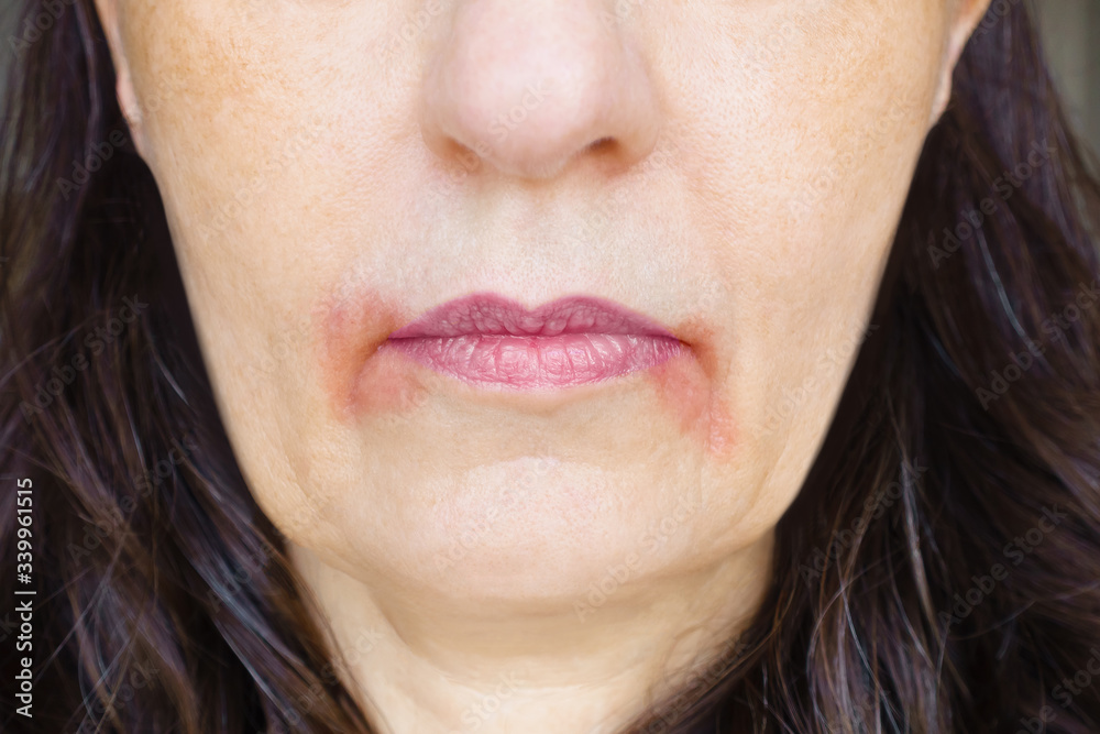 Perleche or perioral dermatitis: health professional with big red spots ...
