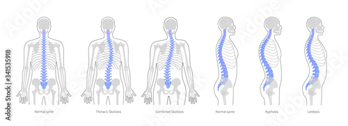 Spinal deformity flat vector illustration Stock Vector | Adobe Stock