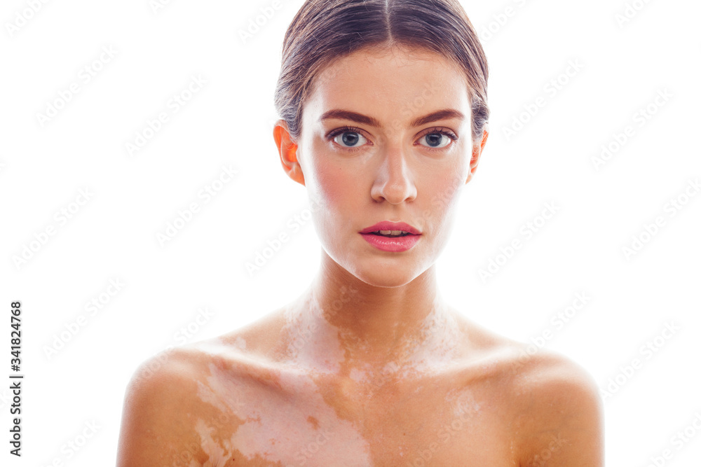 beautiful young brunette woman with vitiligo disease isolated on white ...