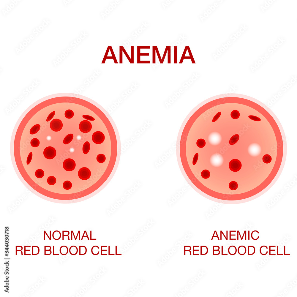 Infographic image of anemia .The difference of Anemia amount of red ...