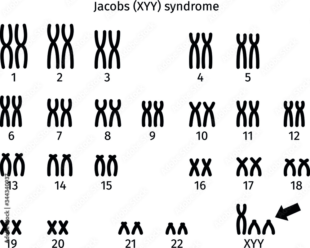 Стоковое векторное изображение «Scheme of Jacobs (XYY) syndrome ...