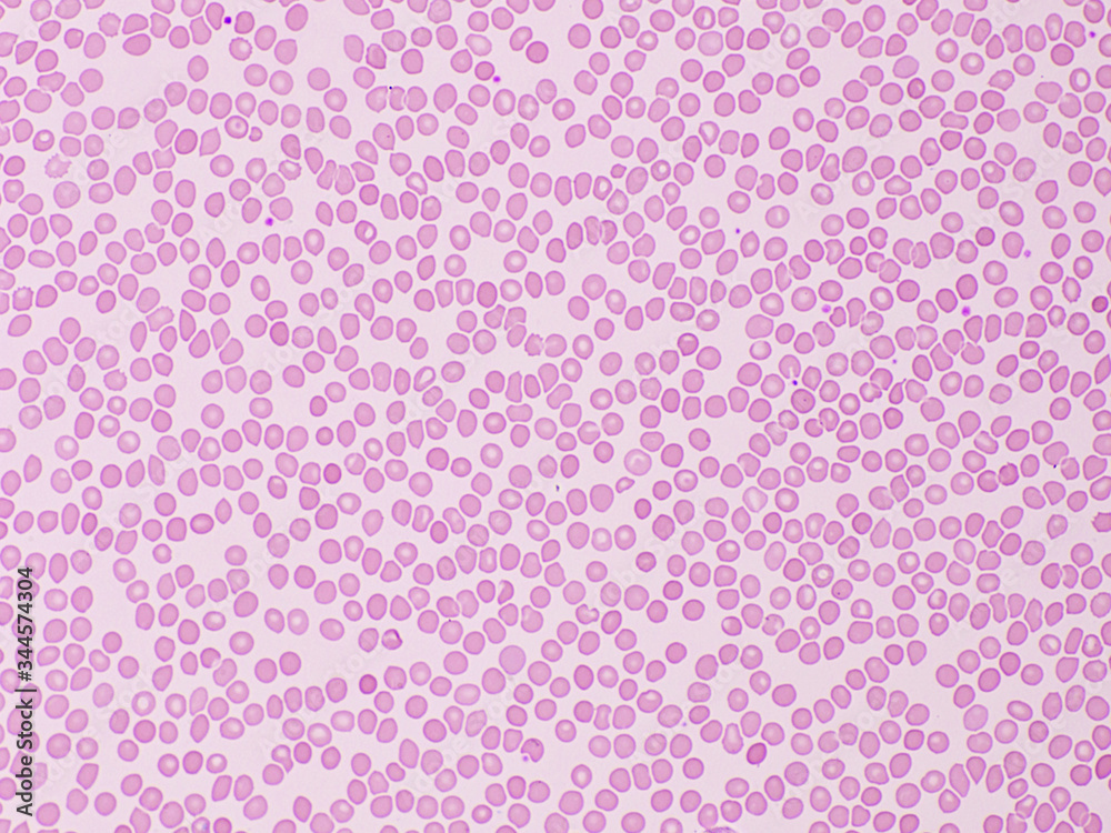 Red blood cells in blood smear, Wright-Giemsa stain, analyze by ...