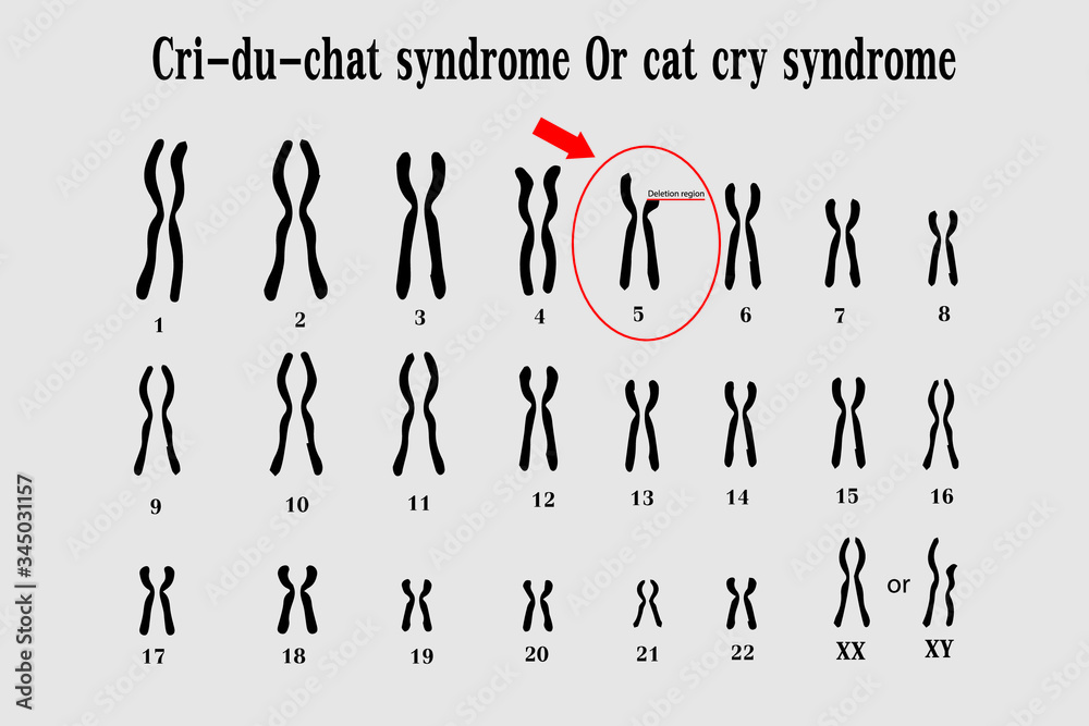 Stock-Vektorgrafik „Cri du chat syndrome , also known as 5p- (5p minus ...