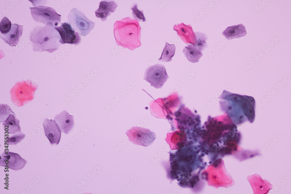View in microscopic of Candidiasis, fungus infection (Yeast and ...
