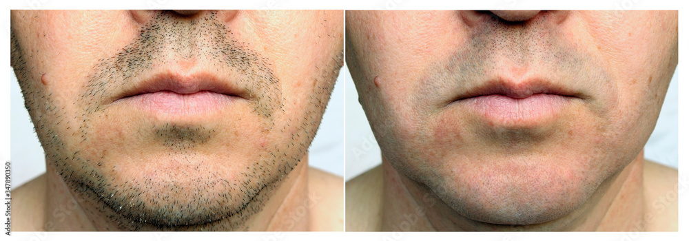 A set of two photographs of men before and after shaving. After shave ...