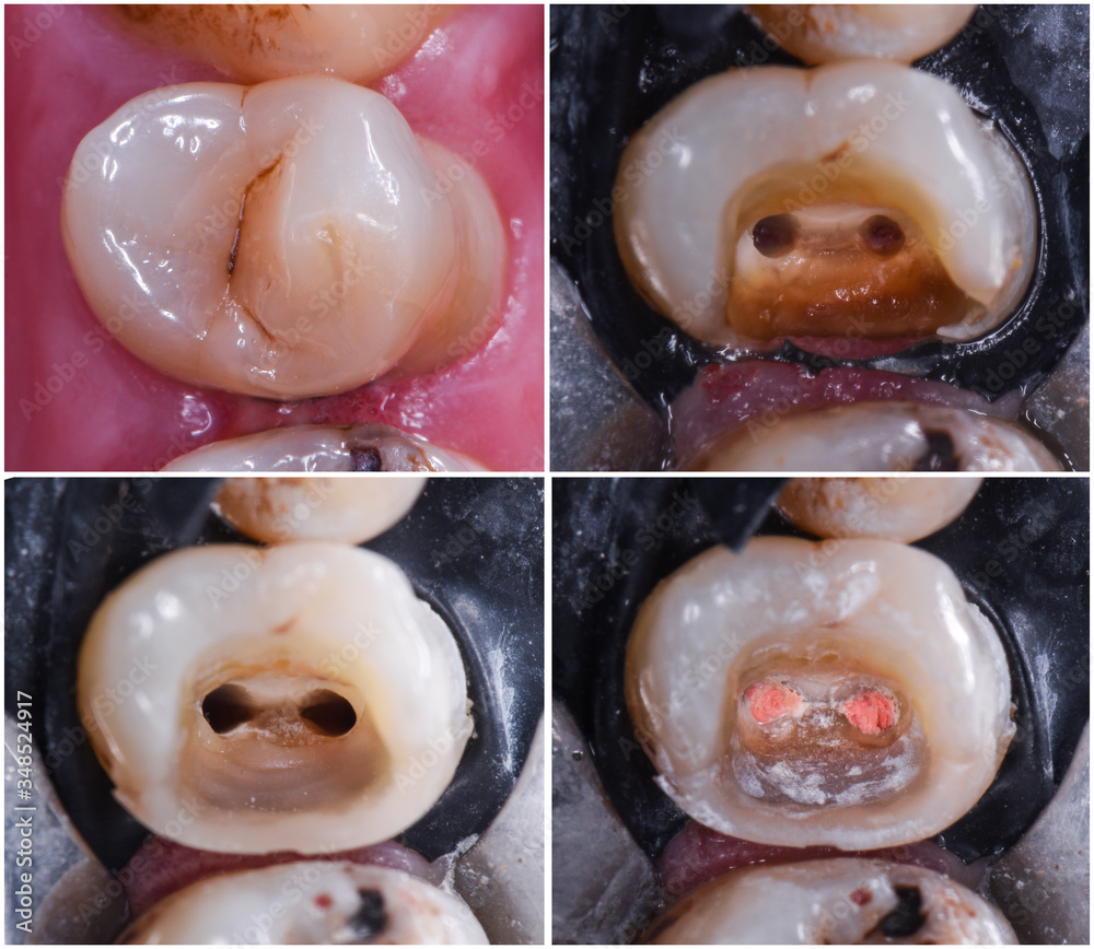root canal treatment under dental microscope Stock Photo | Adobe Stock