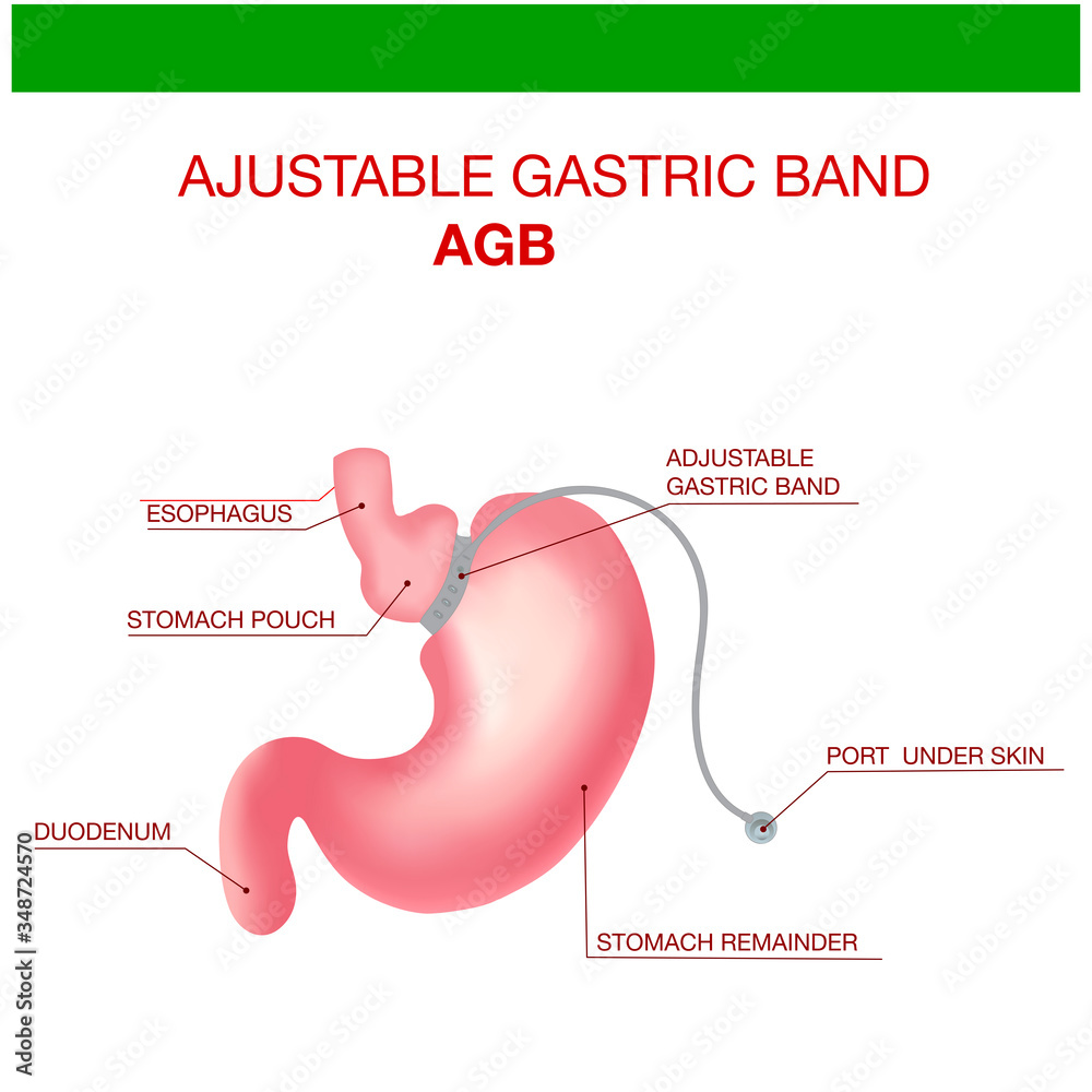 laparoscopic adjustable gastric band.Band with a Port that Under the ...