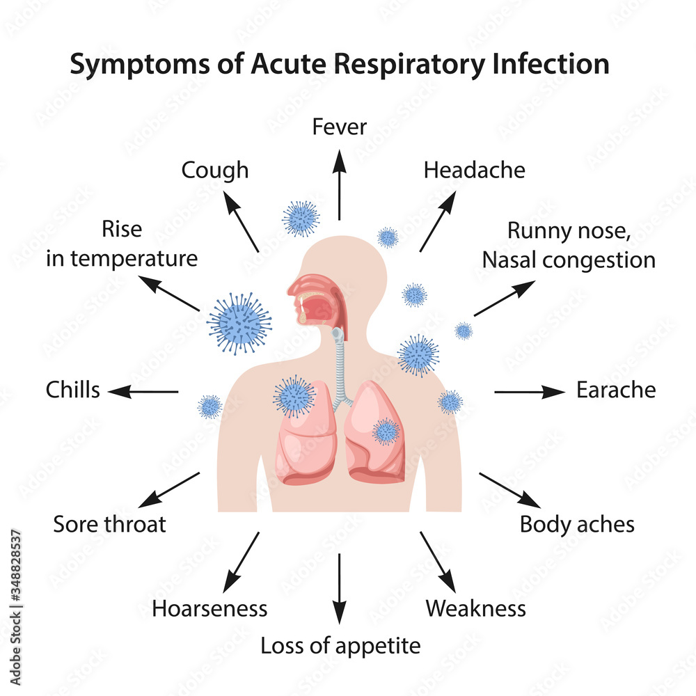 Acute Respiratory Viral Infection. Human body with lungs is attacked by viruses. ARVI Symptoms ...