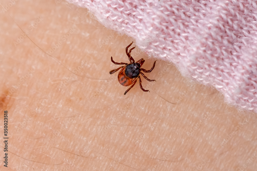 Infected tick on human skin. Carrier of infections of encephalitis ...