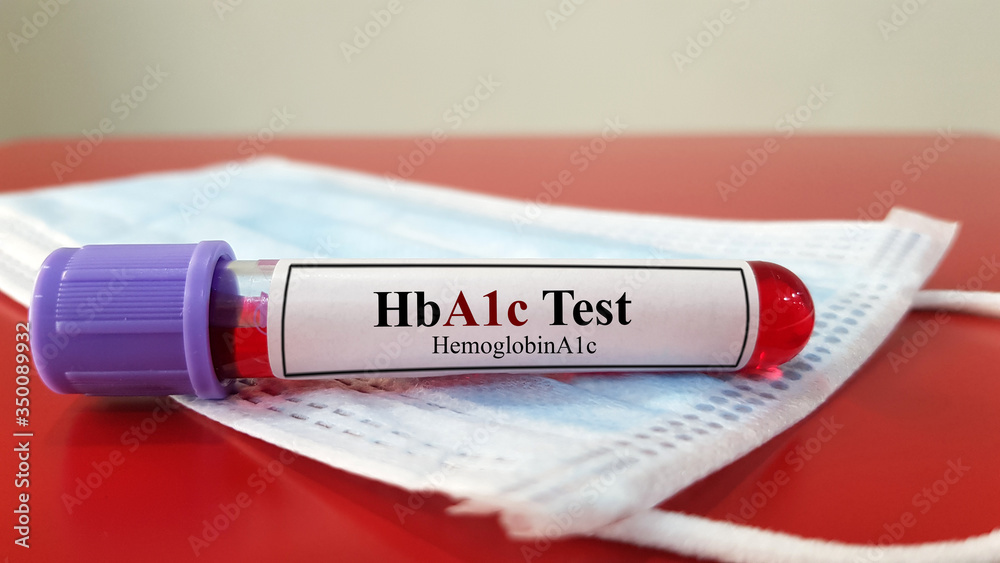 Laboratory sample tube of glycalated hemoglobin or hemoglobin A1C test ...