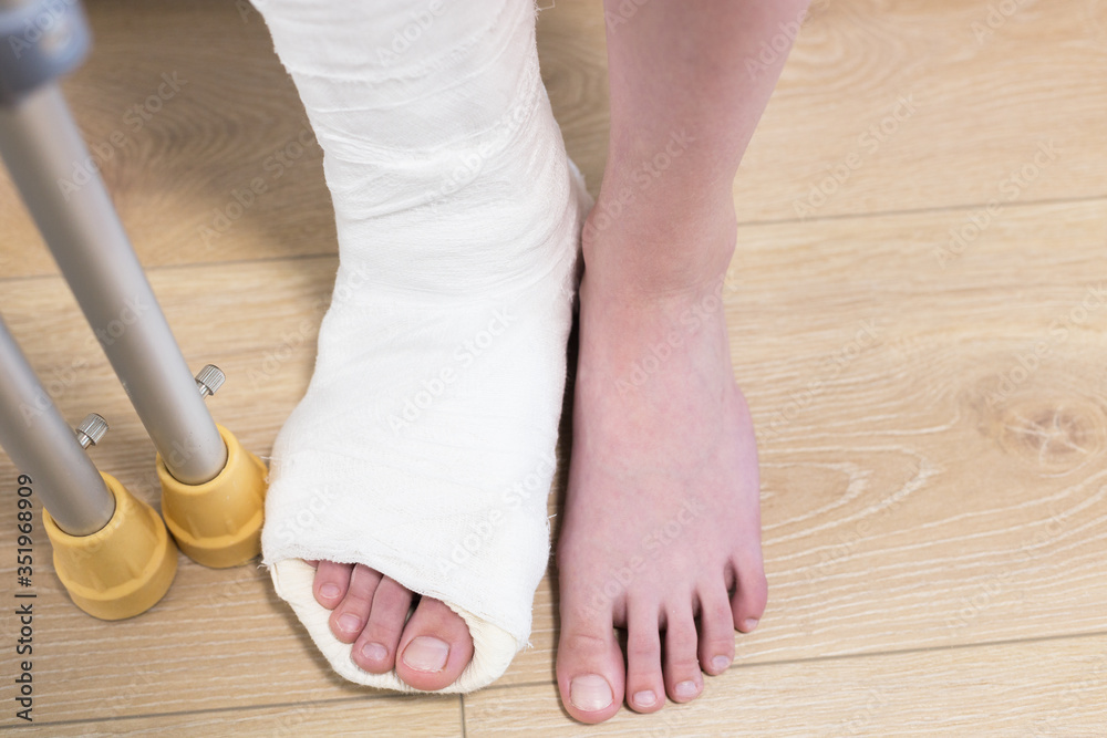 Close-up of children's feet, one leg is broken and in a cast, next to ...