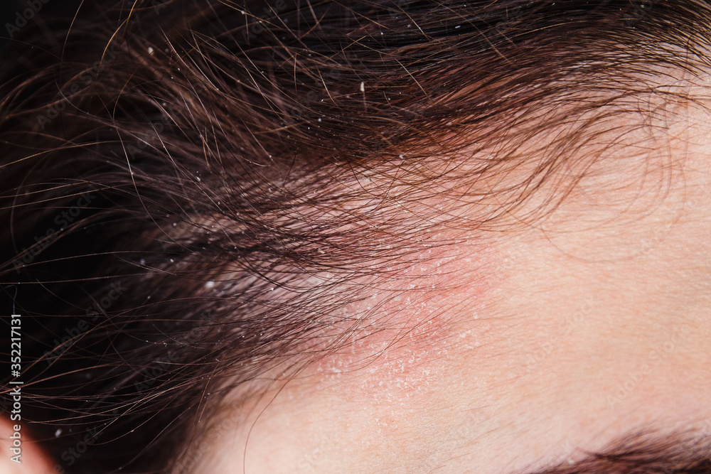 Dandruff in the hair and temples of a young woman. Dry scalp skin ...