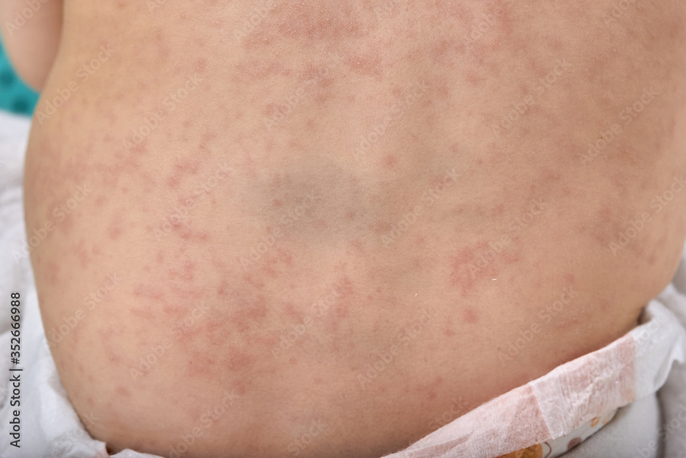roseola rash a viral rash on the skin of a child Stock Photo | Adobe Stock