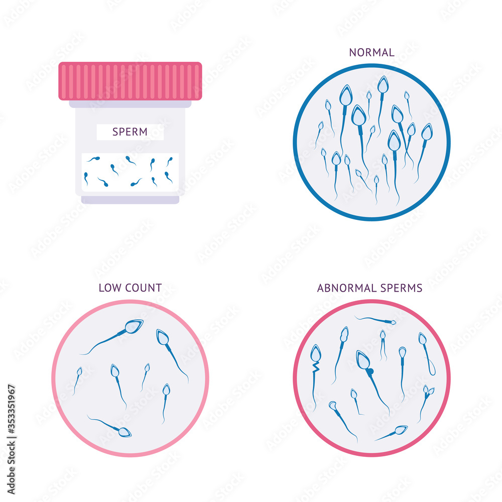 Isolated male infertility set - sperm types and male fertility research ...