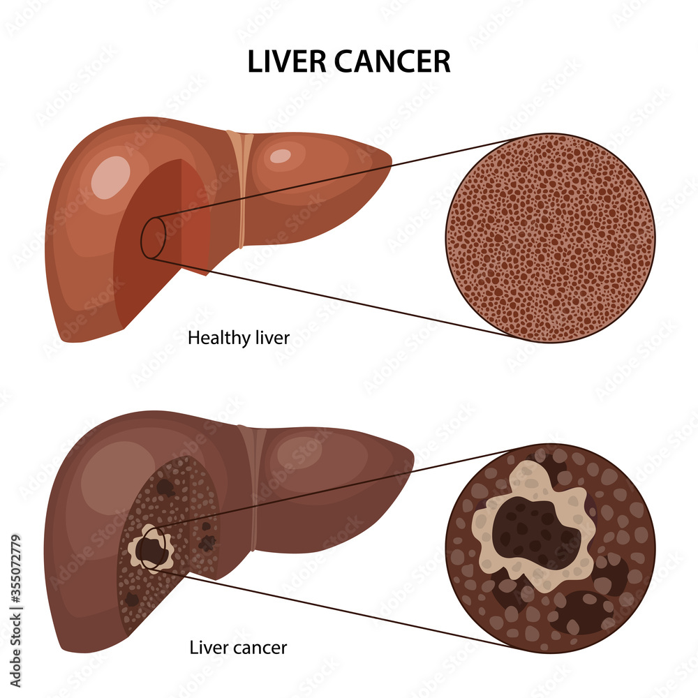 Liver cancer. Histology of the healthy liver and liver cancer with ...