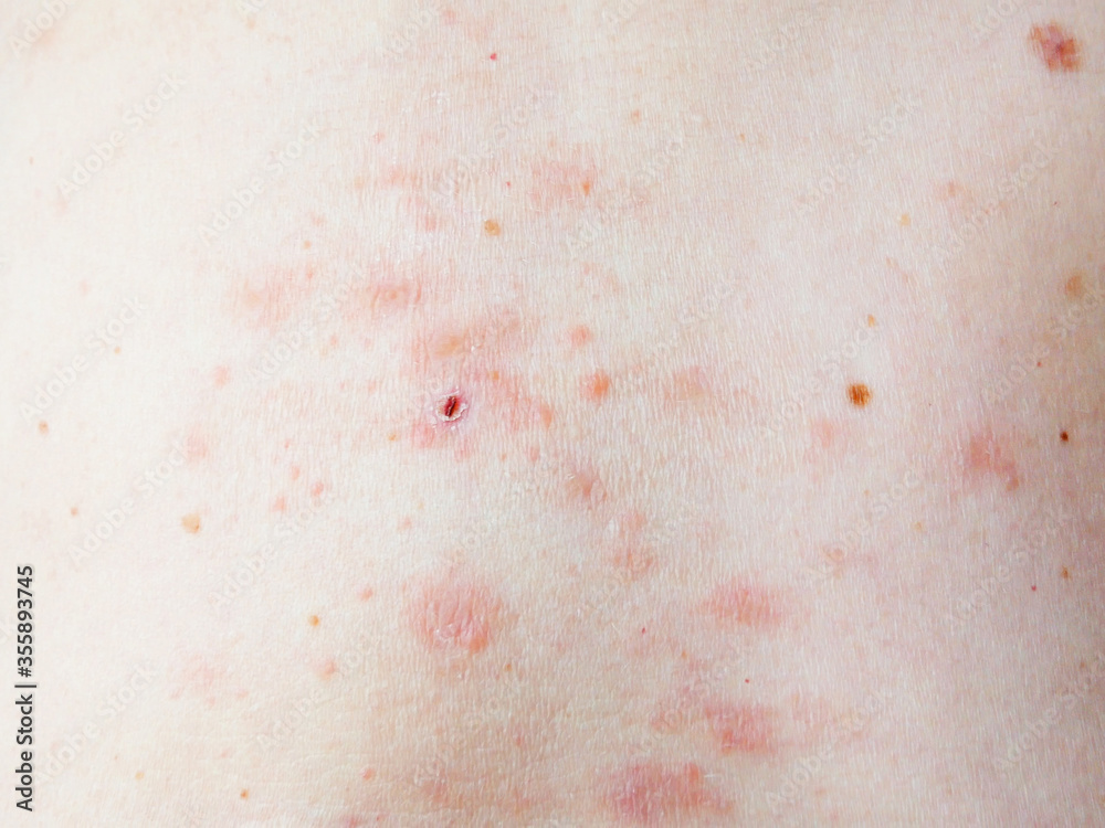 skin rash treatment on woman body. Shingles, Disease, Herpes zoster ...