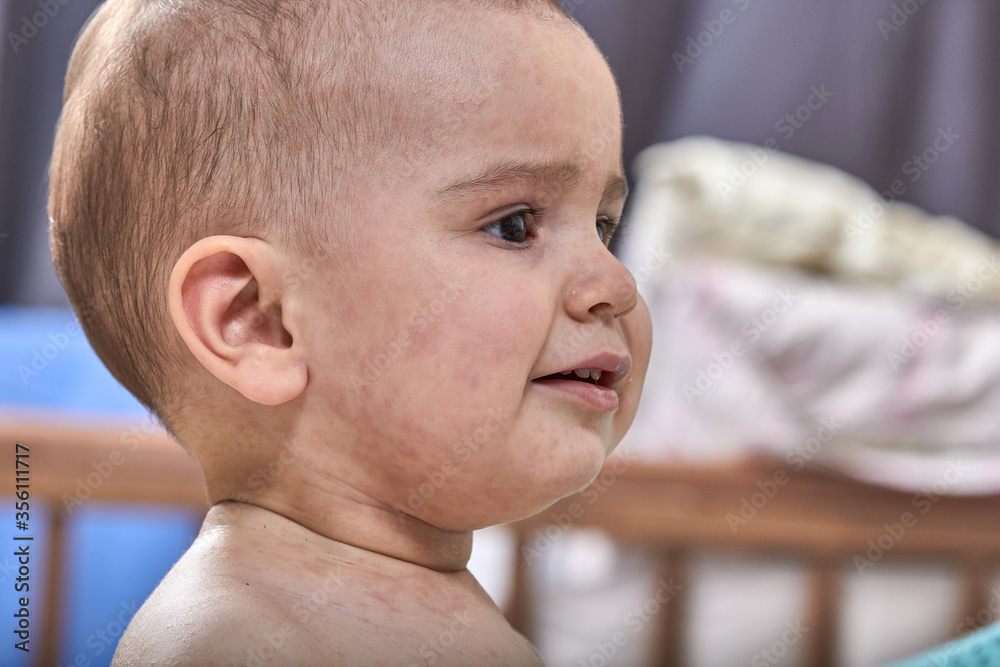 roseola rash a viral rash on the skin of a child Stock Photo | Adobe Stock