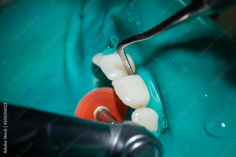 Inspection and treatment of anterior teeth at the dentist, cofferdam is ...