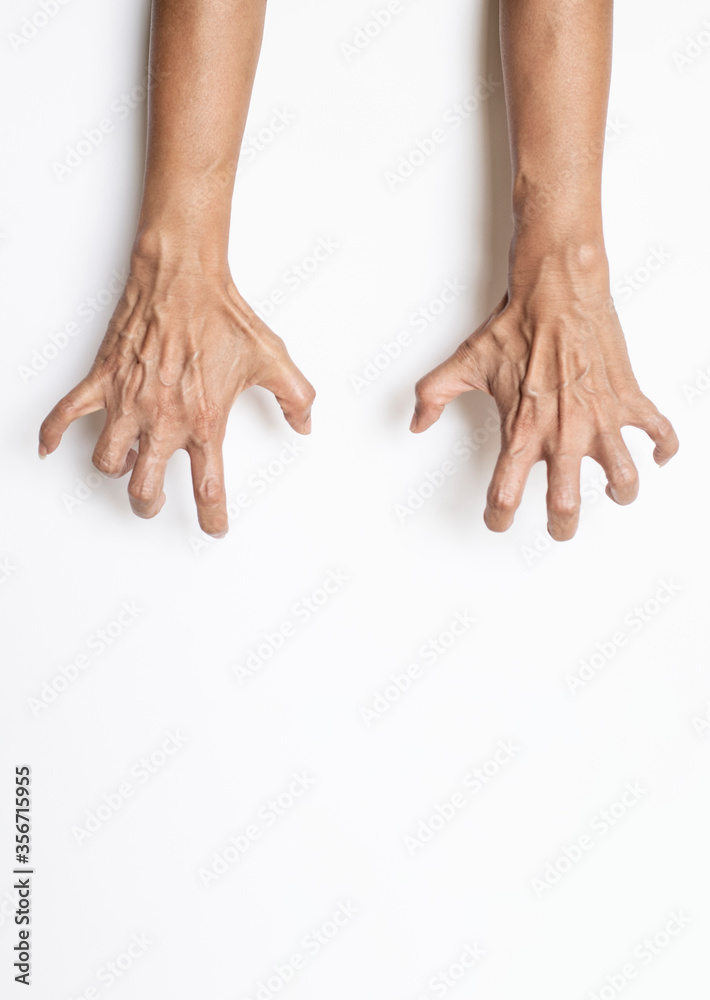 Trigger Finger a defect in a tendon causing a finger to jerk or snap ...