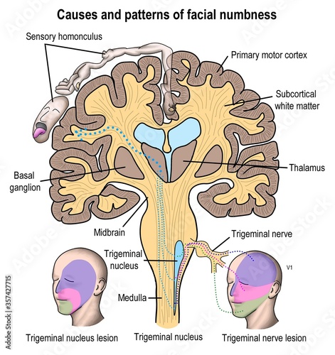 The different distribution of facial sensation regarding to fifth ...