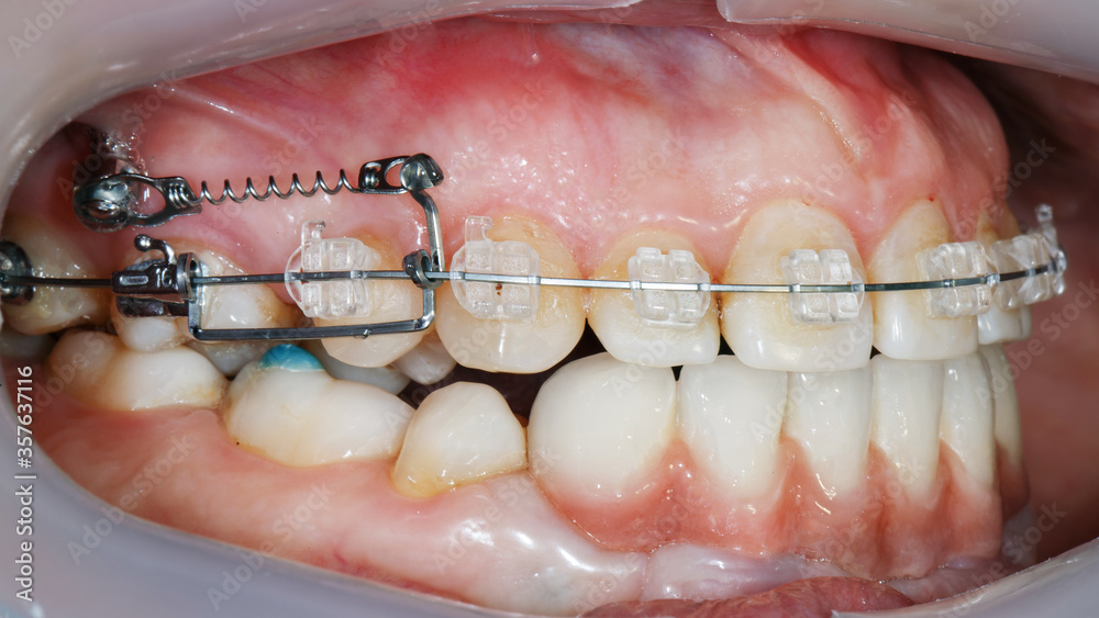 complex brace system for smoothing the patient’s bite Stock Photo ...